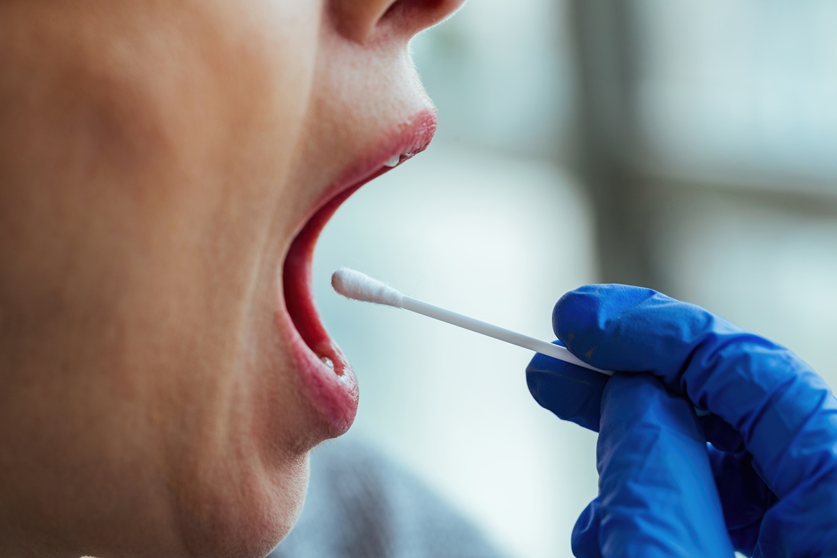 Síntomas de la candidiasis en la boca - Clínica Dental Gran Vía Alic